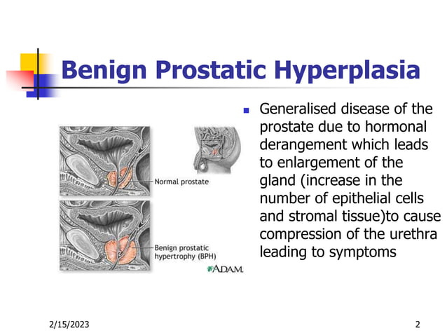 Benign Prostatic Hyperplasia.ppt