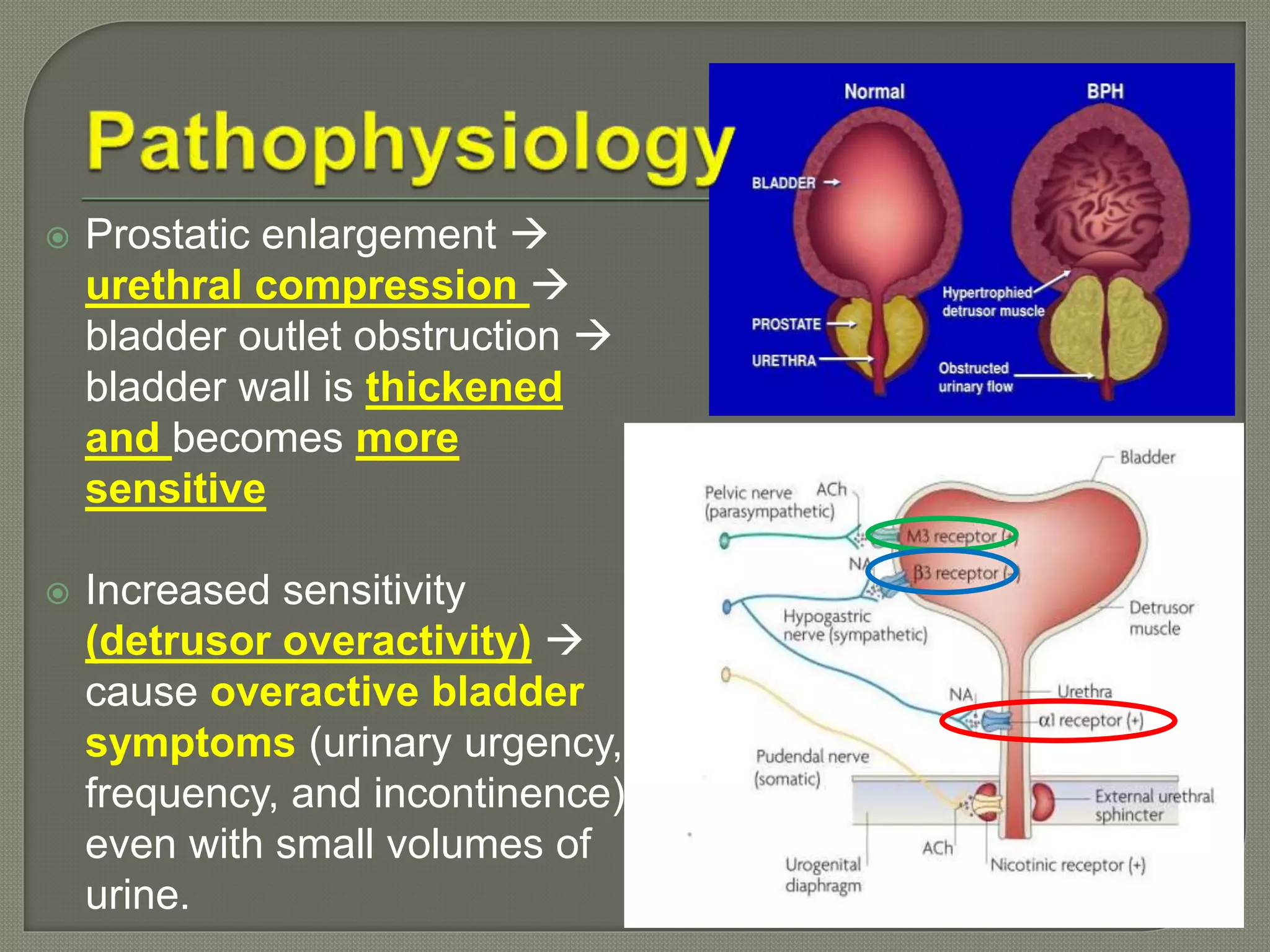 Benign prostatic hyperplasia | PPTX