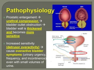 Benign prostatic hyperplasia | PPT