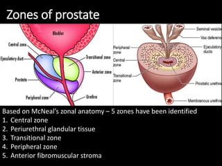 BENIGN PROSTATIC HYPERPLASIA.pptx