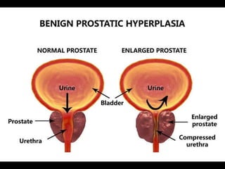 BENIGN PROSTATIC HYPERPLASIA.pptx
