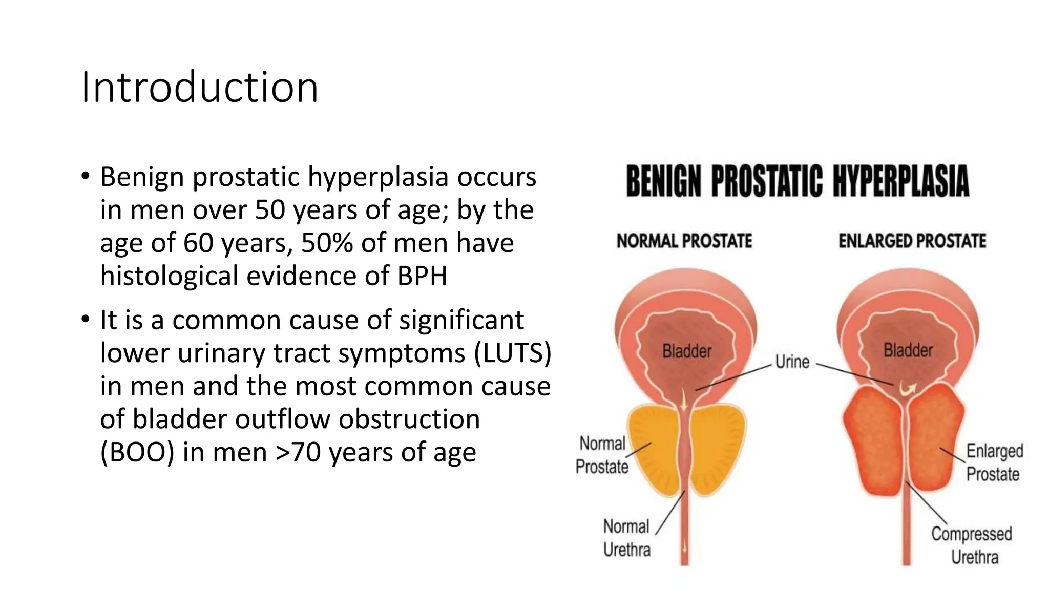 BENIGN PROSTATIC HYPERPLASIA LUTS management | PPT