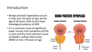 BENIGN PROSTATIC HYPERPLASIA LUTS management | PPT