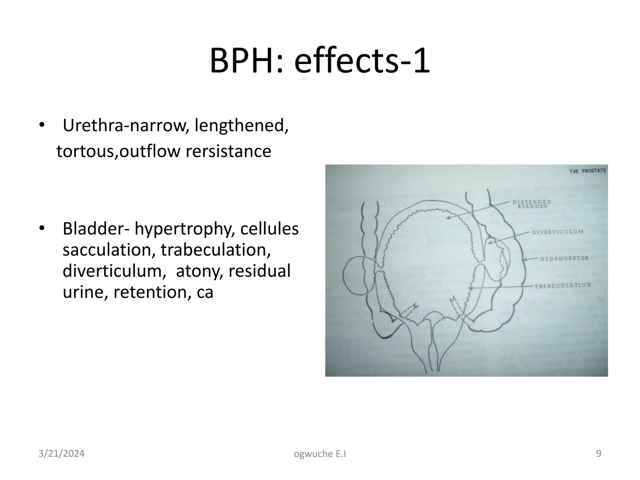 BENIGN PROSTATIC HYPERPLASIA for MBBS 600L Students | PPTX