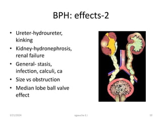 BENIGN PROSTATIC HYPERPLASIA for MBBS 600L Students | PPTX | Endocrine ...
