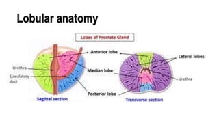 BENIGN PROSTATIC HYPERPLASIA.BPH. BPHpdf | PDF