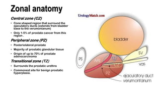 BENIGN PROSTATIC HYPERPLASIA.BPH. BPHpdf | PDF