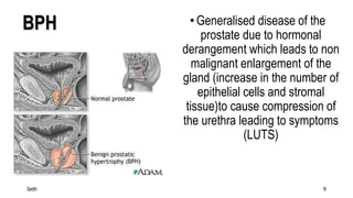 BENIGN PROSTATIC HYPERPLASIA.BPH. BPHpdf | PDF