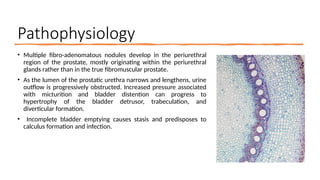 Benign prostatic hyperplasia presentation.ppsx