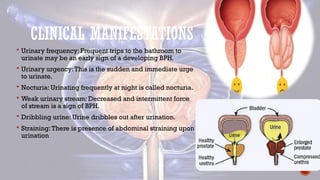 BENIGN PROSTATIC HYPERPLASIA pptx | PPTX