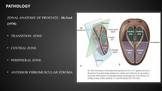 Benign Prostatic Hyperplasia -Etiology, Clinical Features and ...