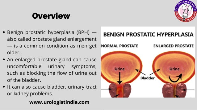 Benign prostatic hyperplasia - symptoms and causes