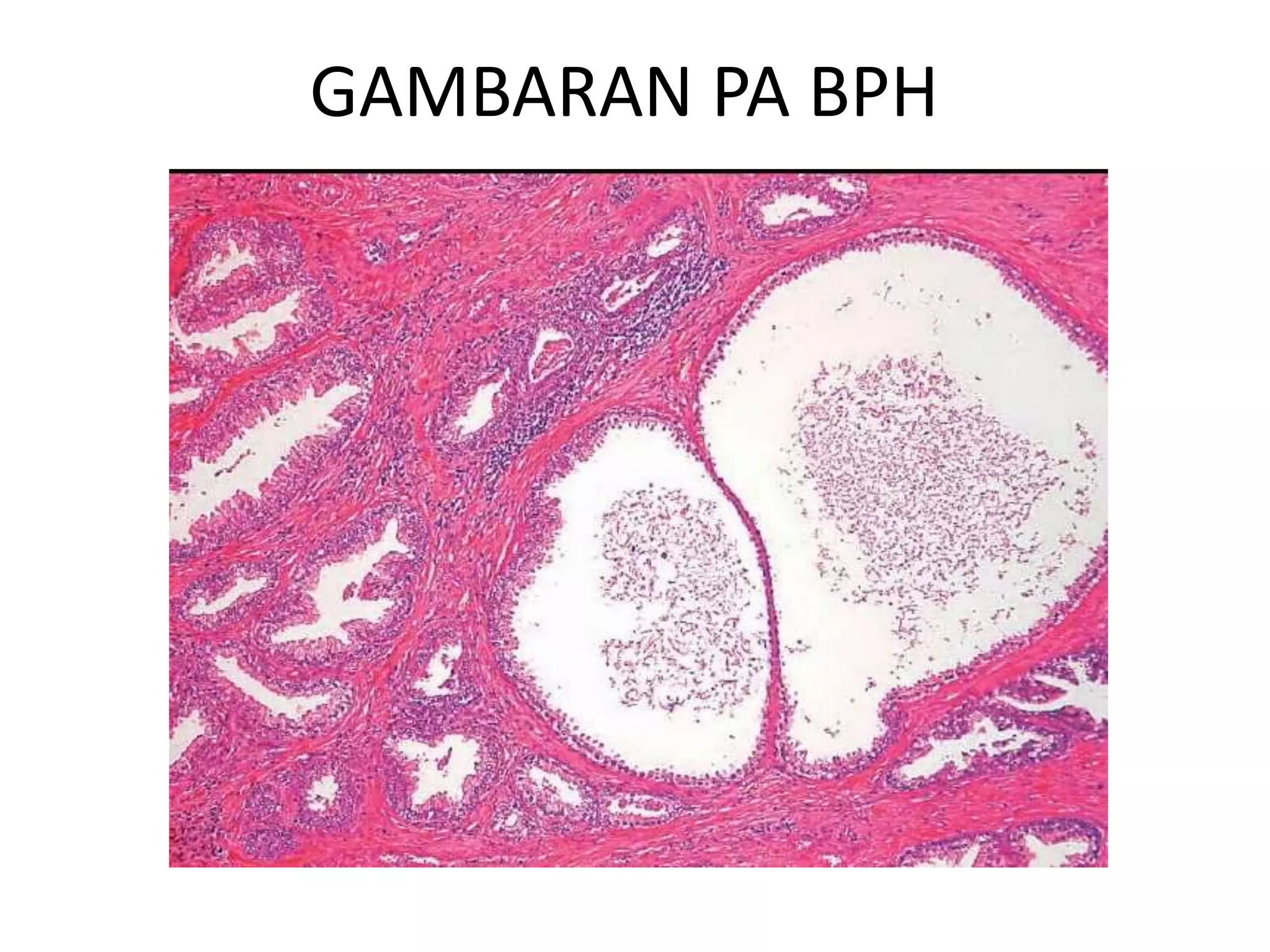 Benign prostatic hyperplasia (bph) | PPTX