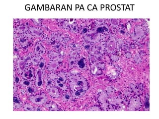 Benign prostatic hyperplasia (bph) | PPTX