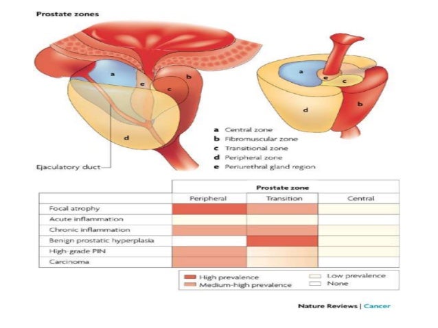 Benign prostatic hyperplasia (bph)