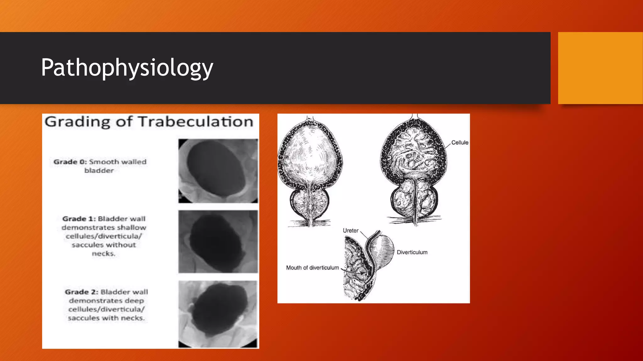 Benign prostatic hyperplasia (bph) | PPTX
