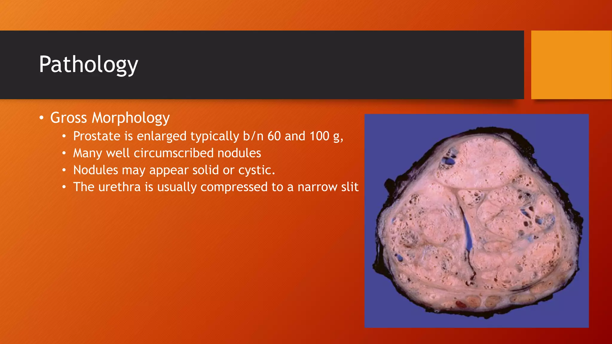 Benign Prostatic Hyperplasia Bph Ppt