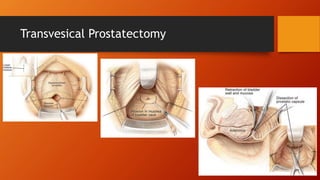 Benign prostatic hyperplasia (bph) | PPTX