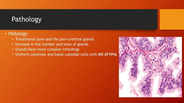Benign prostatic hyperplasia (bph) | PPTX