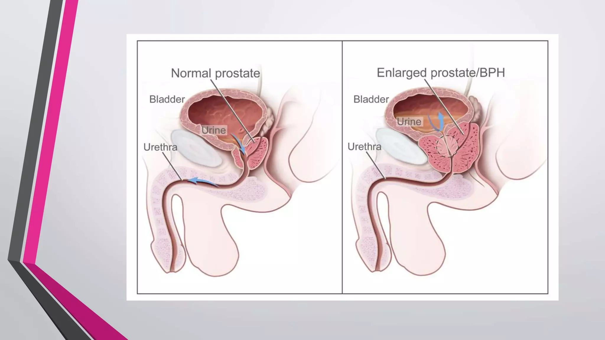 Benign prostatic hyperplasia (bph) | PPTX