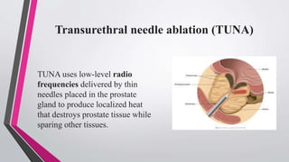 Benign prostatic hyperplasia (bph) | PPTX