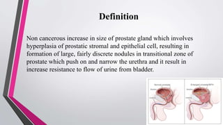 Benign prostatic hyperplasia (bph) | PPTX