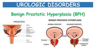 Benign Prostatic Hyperplasia (BPH)-I CU_250914_163946.pdf