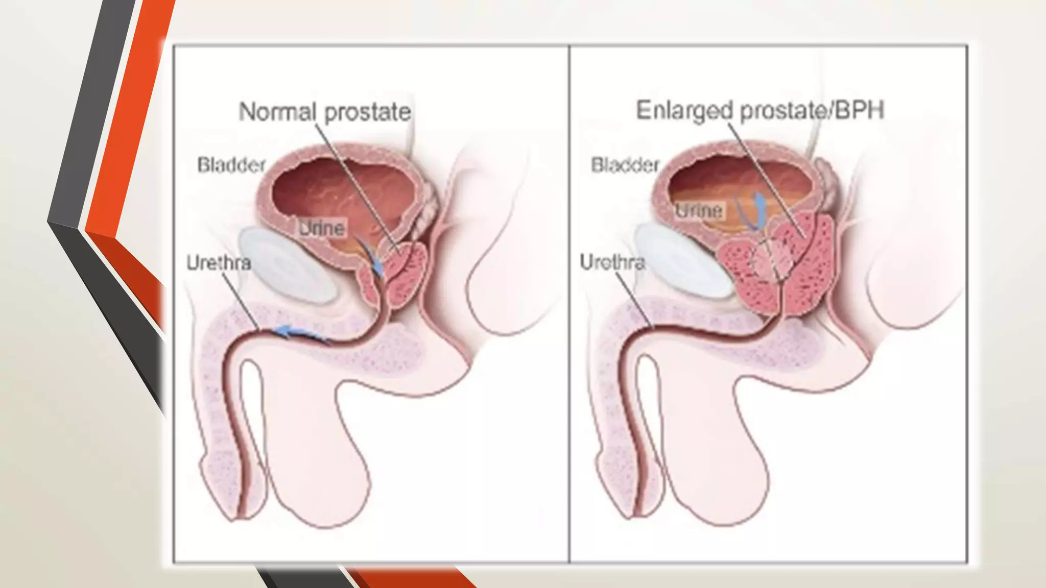 Benign Prostatic Hyperplasia (BPH) - Rivin | PPTX