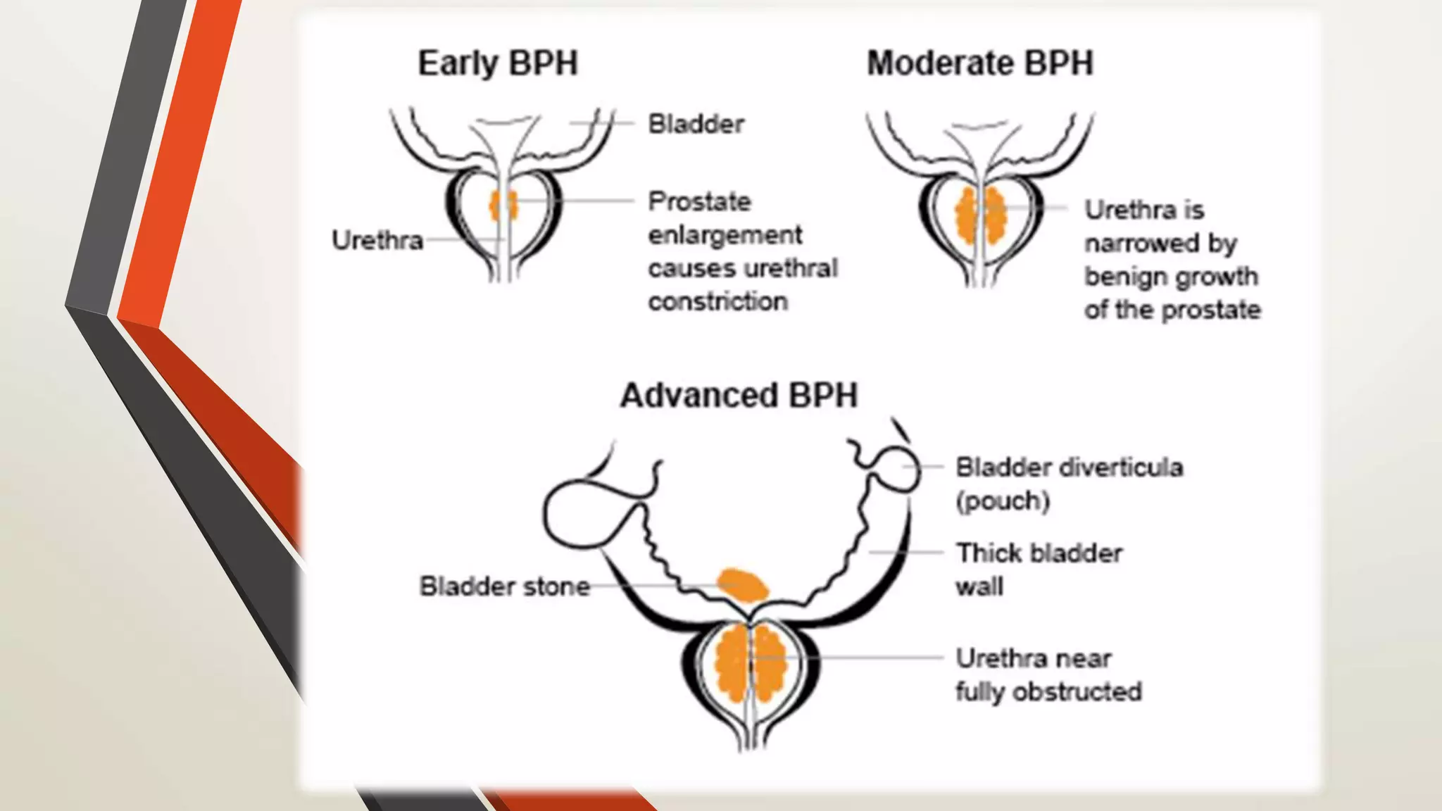 Benign Prostatic Hyperplasia (BPH) - Rivin | PPTX