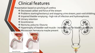 Benign Prostatic Hyperplasia (BPH) - Rivin | PPTX