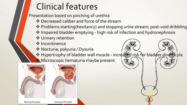 Benign Prostatic Hyperplasia (BPH) - Rivin | PPT