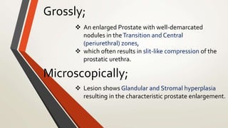 Benign Prostatic Hyperplasia (BPH) - Rivin | PPT