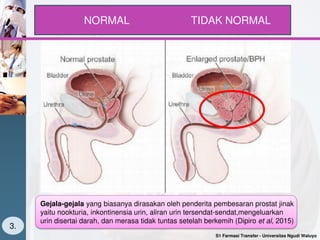 Benign_Prostatic_Hyperplasia_BPH_PPT_Pem.pdf