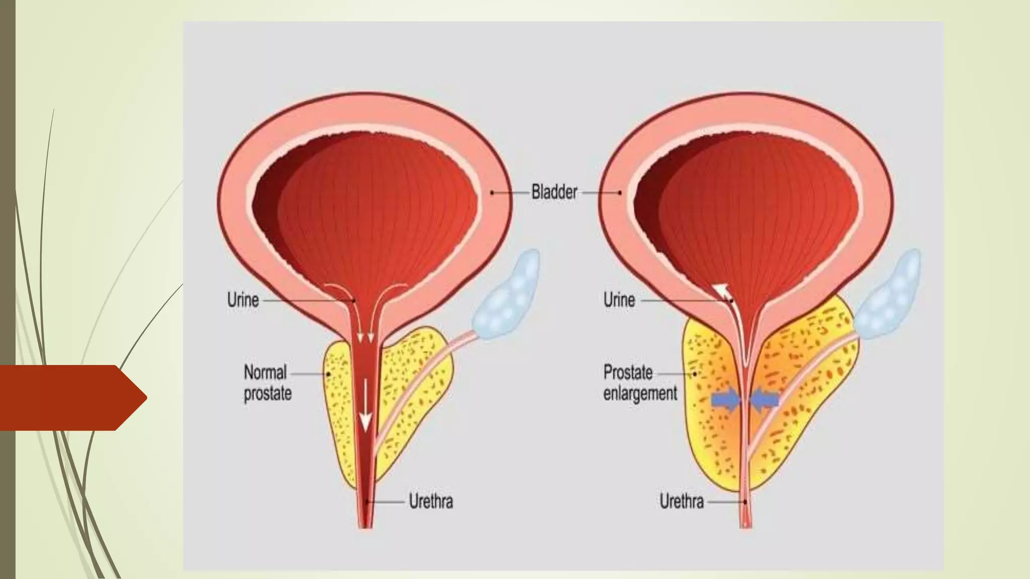 BENIGN PROSTATIC HYPERPLASIA PPT.pptx | Sexual Conditions | Sexual Health