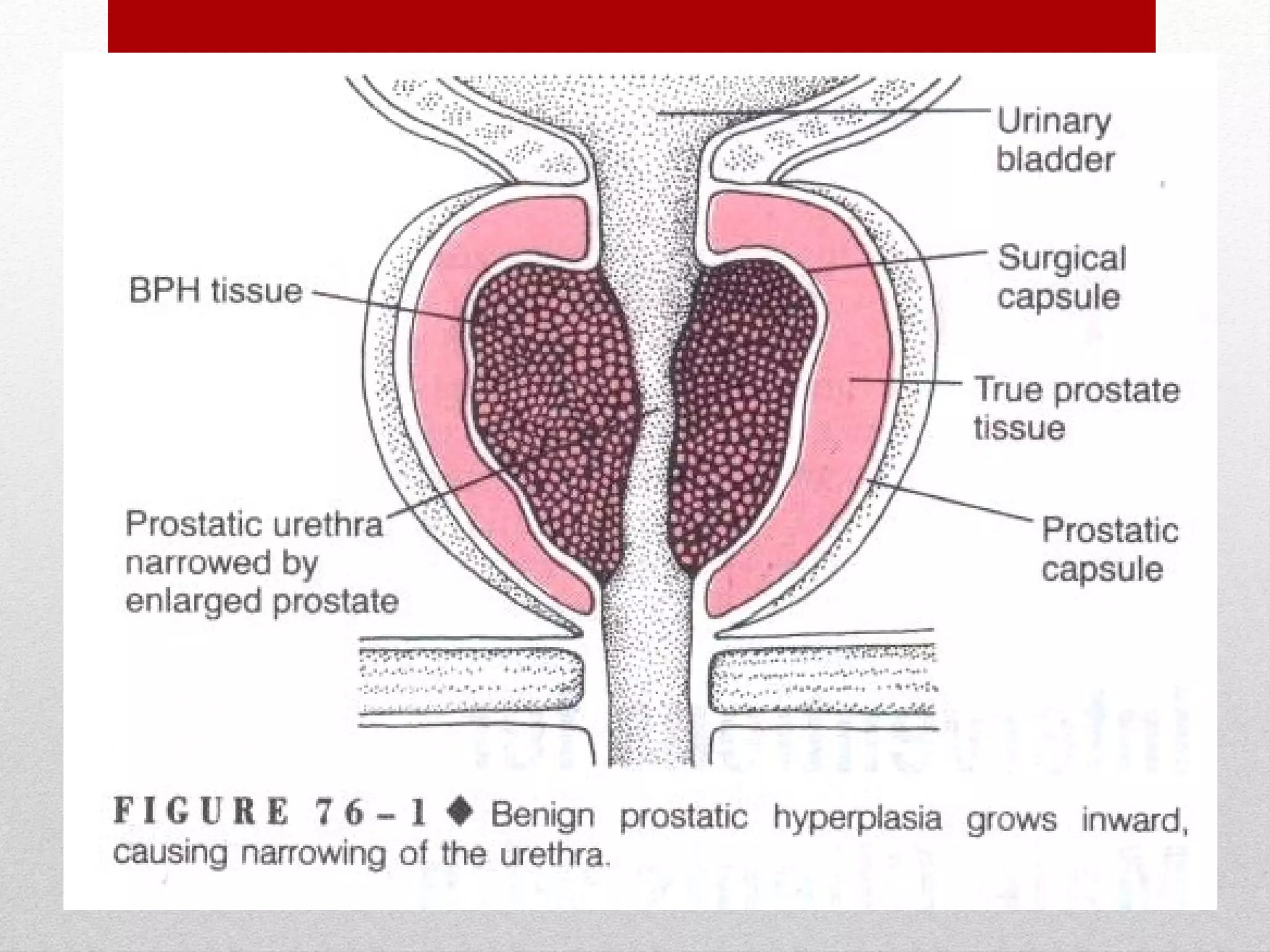 BENIGN PROSTATIC HYPERTROPHY (BPH) | PPT