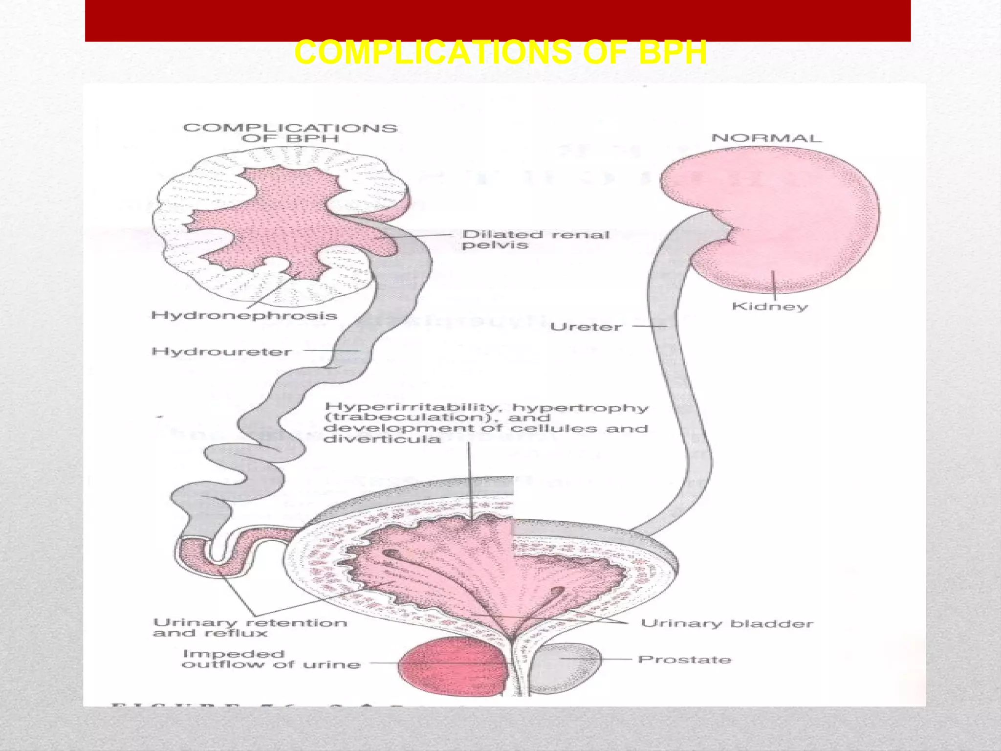 BENIGN PROSTATIC HYPERTROPHY (BPH) | PPT