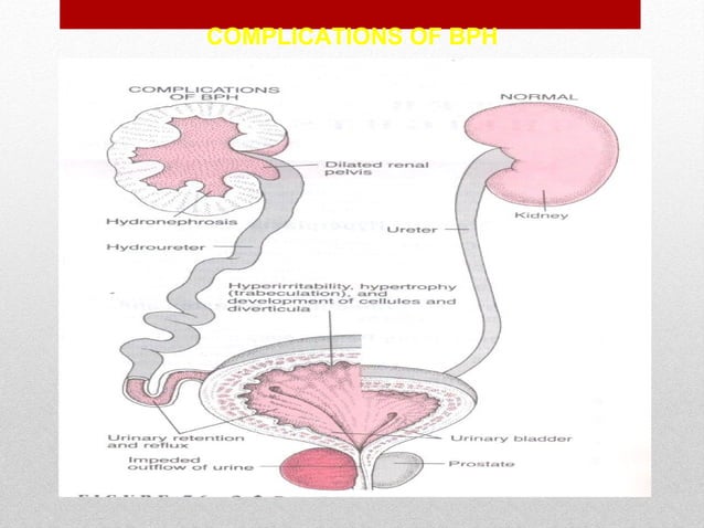 BENIGN PROSTATIC HYPERTROPHY (BPH) | PPT