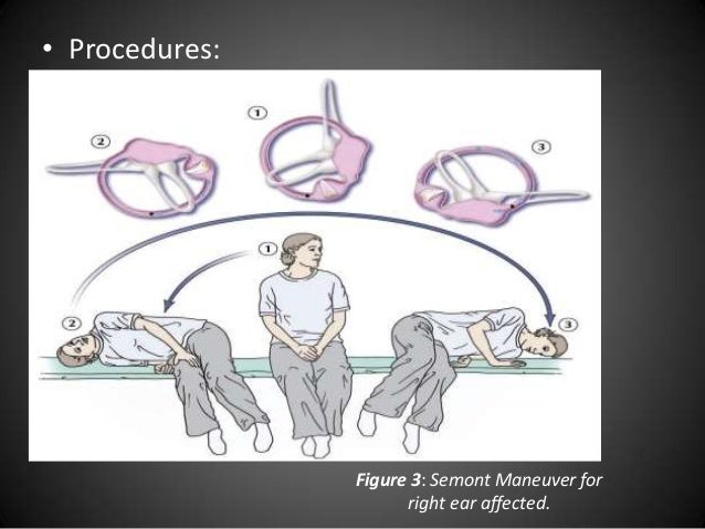 Benign proxysmal positional vertigo