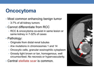 Curriculum Conference - Benign Renal Tumors | PPT