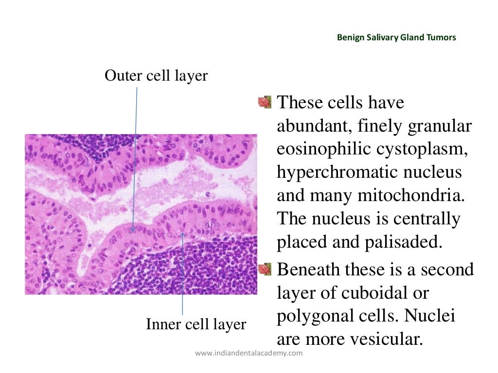 Benign salivary gland tumor 2/dental courses
