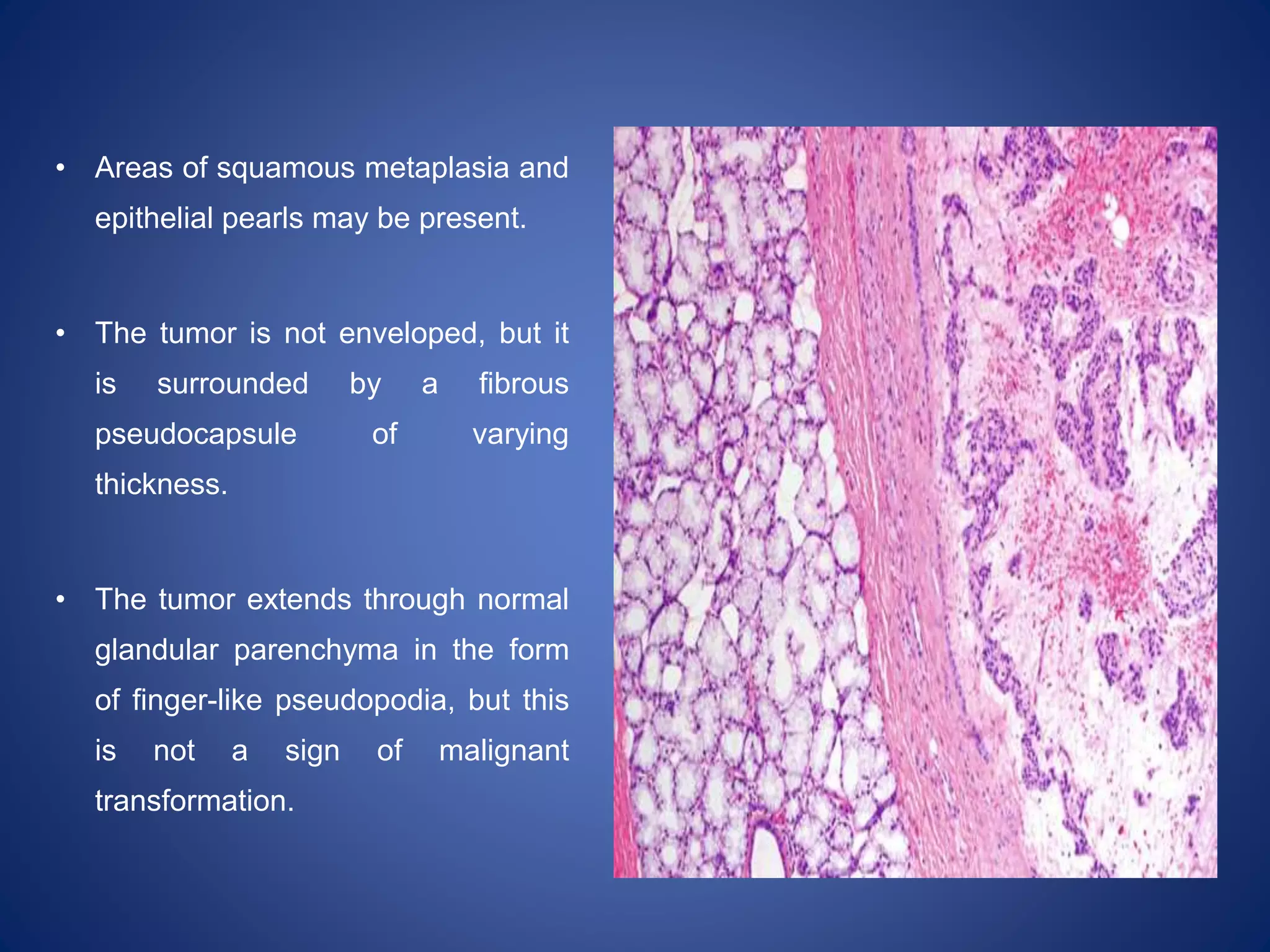 Benign salivary gland tumor BY DR. C. P. ARYA (B.Sc. B.D.S.; M.D.S.; P.M.S.; R.N.T.C.P.) | PPTX ...