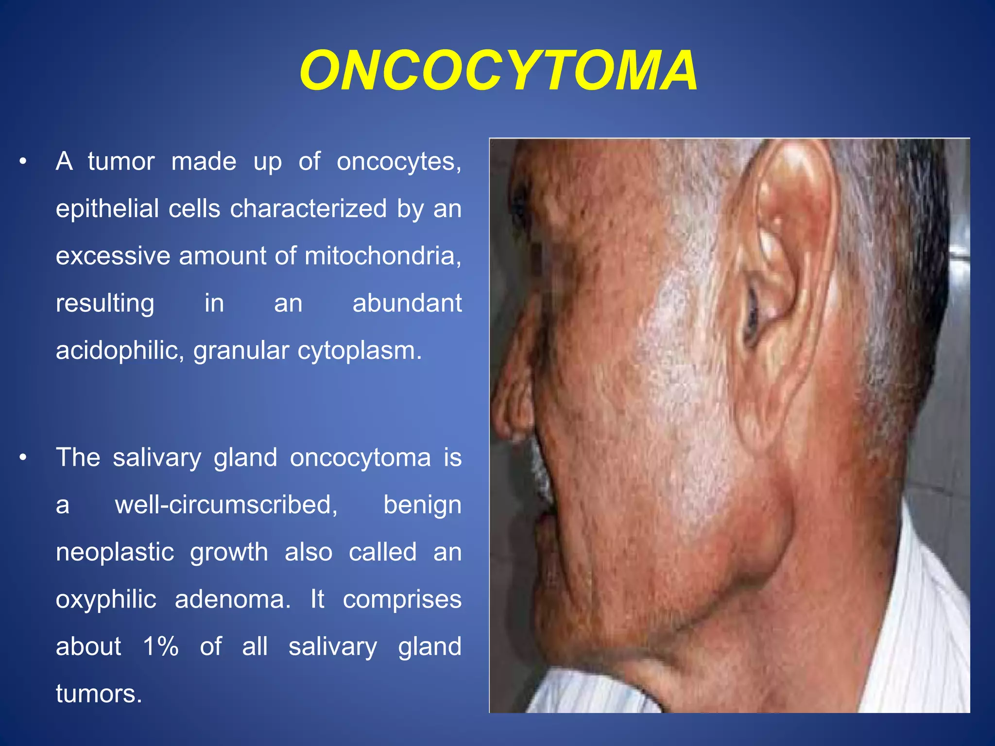 Benign salivary gland tumor BY DR. C. P. ARYA (B.Sc. B.D.S.; M.D.S.; P ...