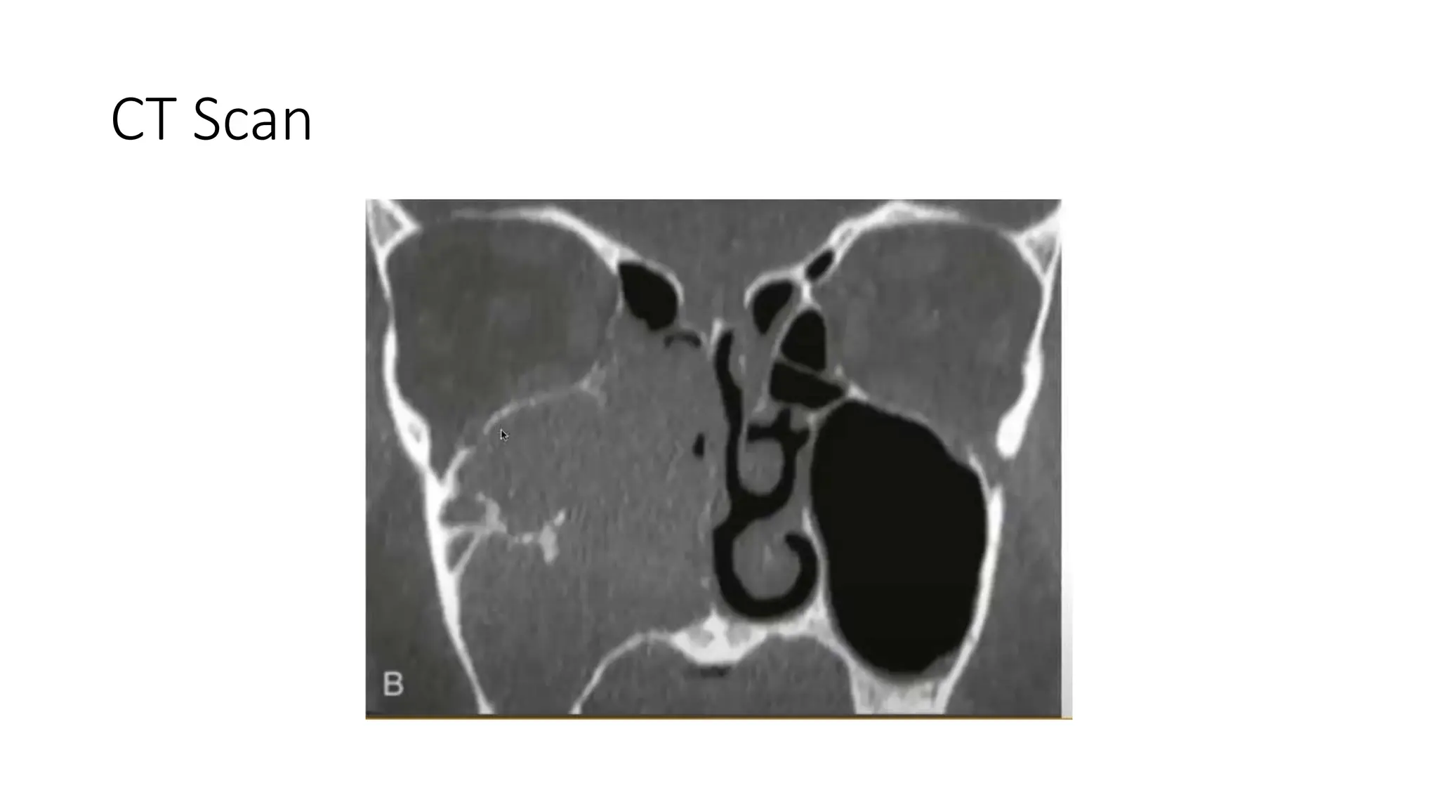Inverted Papilloma and Other Benign Sino-Nasal Tumors | PPTX