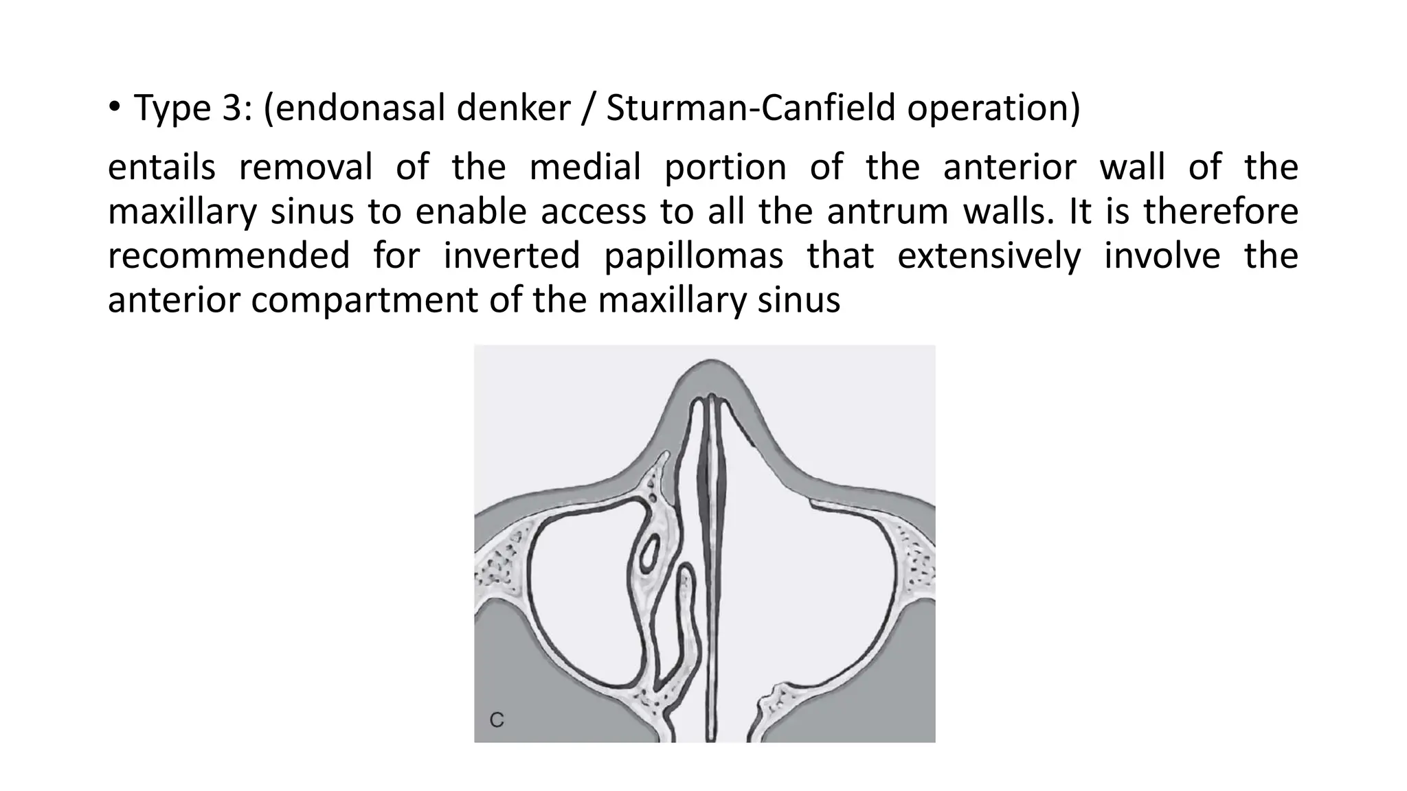 Inverted Papilloma and Other Benign Sino-Nasal Tumors | PPTX