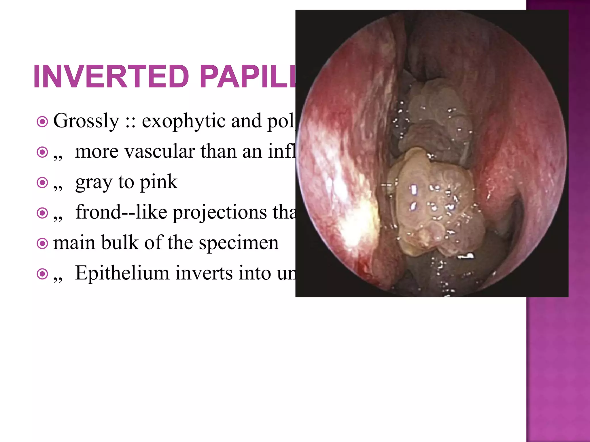 Benign sinonasal masses presentation & management-1 | PPTX