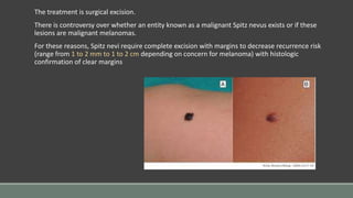 Spitz Nevus Margins