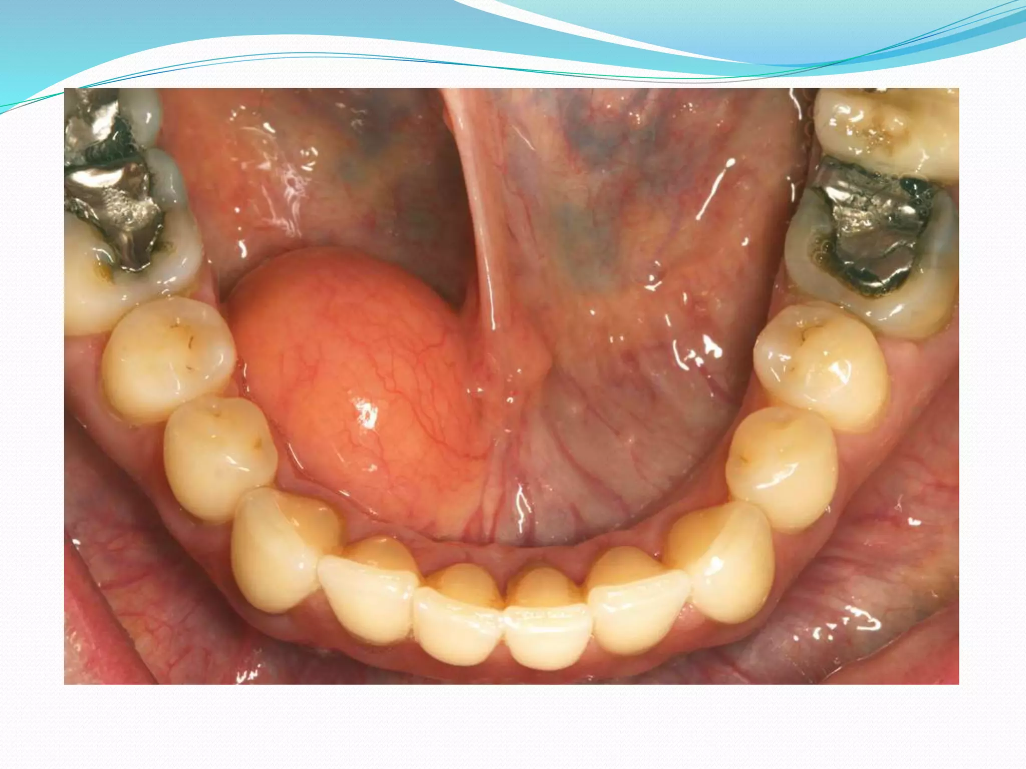 Benign soft tissue tumors | PPTX