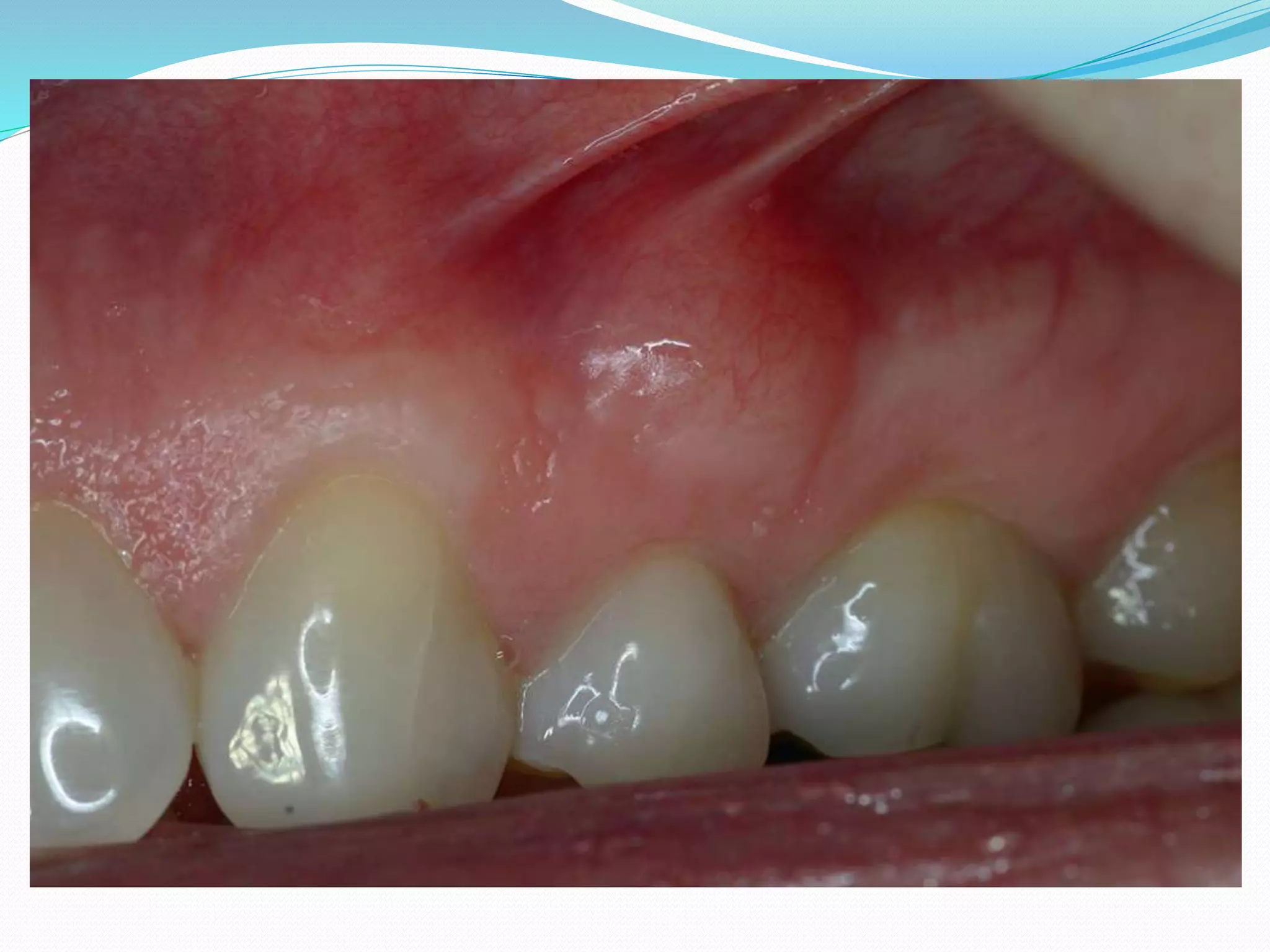 Benign soft tissue tumors | PPTX