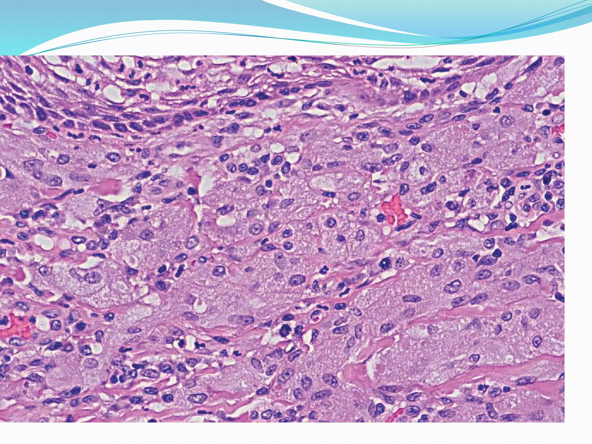 Benign soft tissue tumors | PPTX