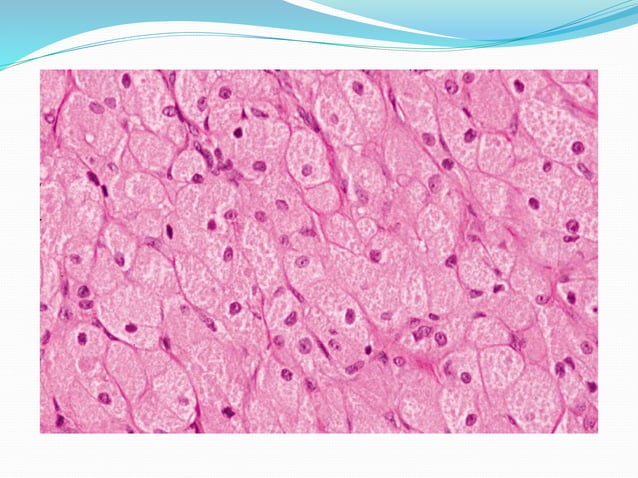 Benign soft tissue tumors | PPTX